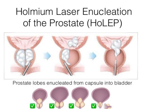 Treatment of BPH - HoLEP - Prostate Matters