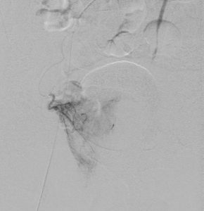 Treatment of BPH - PAE - Prostate Matters
