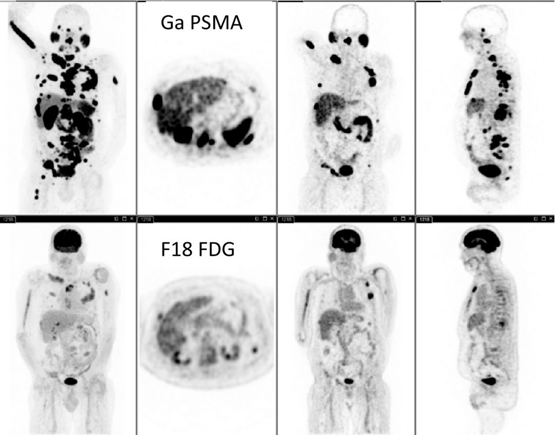 Diagnosing metastatic spread outside the prostate - Prostate Matters