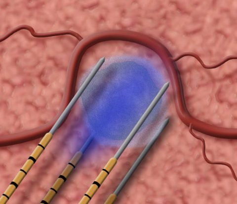 Where to access Nanoknife - Prostate Matters