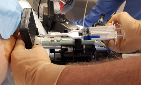 Prostate cancer treatment - Brachytherapy - Prostate Matters