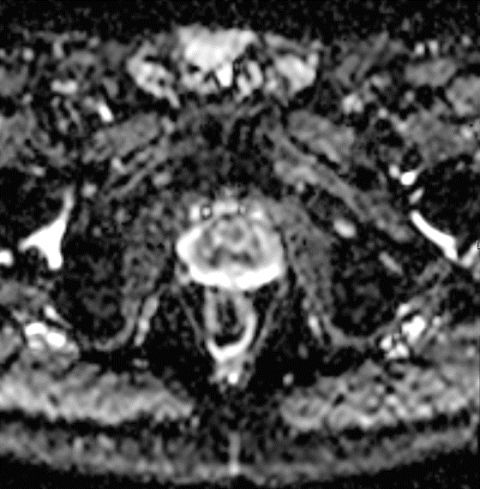 Screening for prostate cancer using biparametric (bp) MRI - Prostate ...